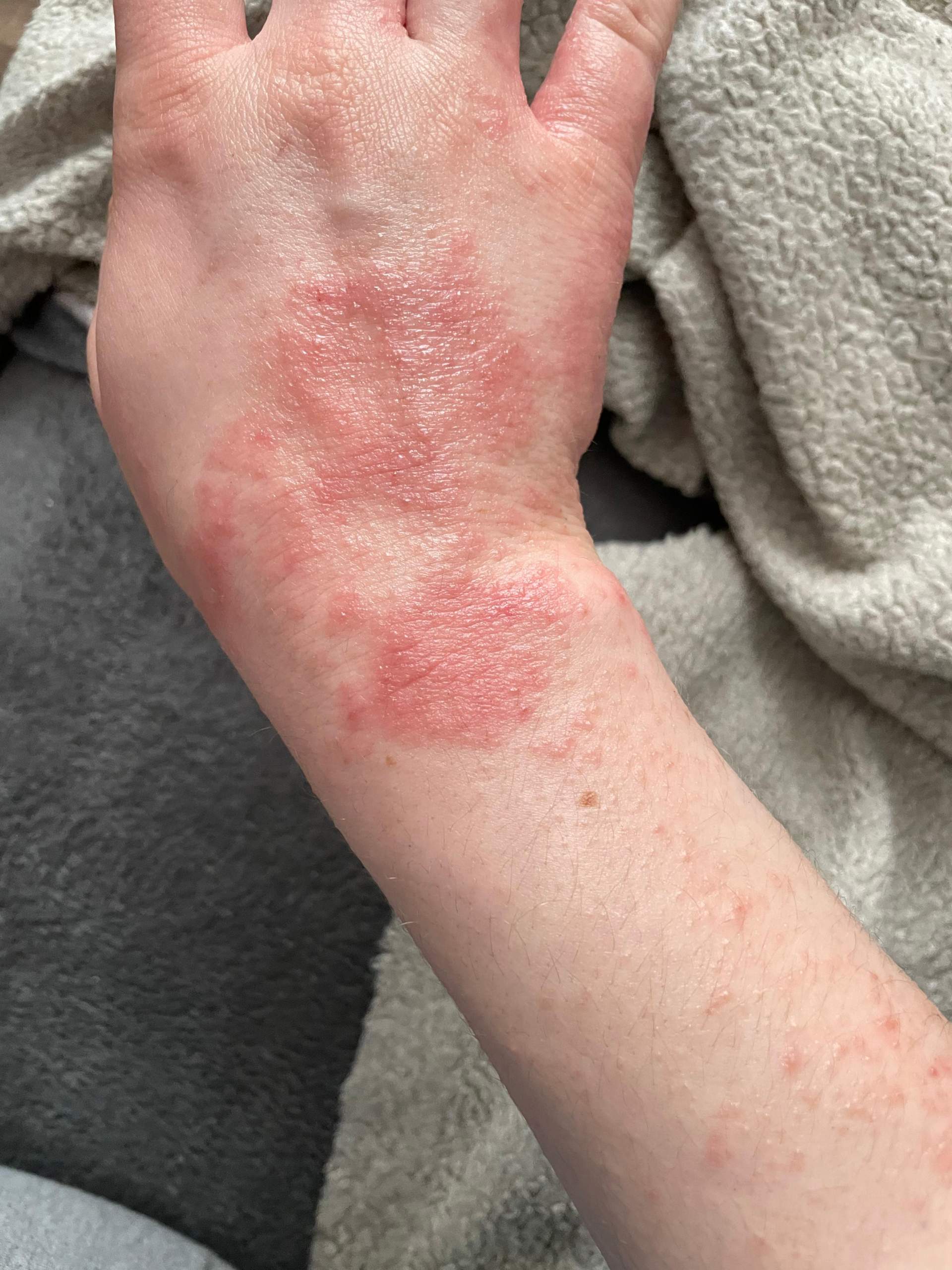 Neurodermitis? (Haut)