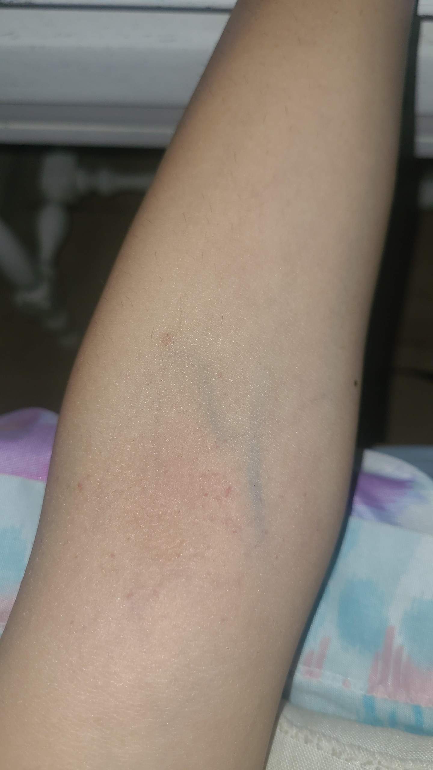 Petechien am arm gefährlich? (Angst, Haut, Hautpflege)