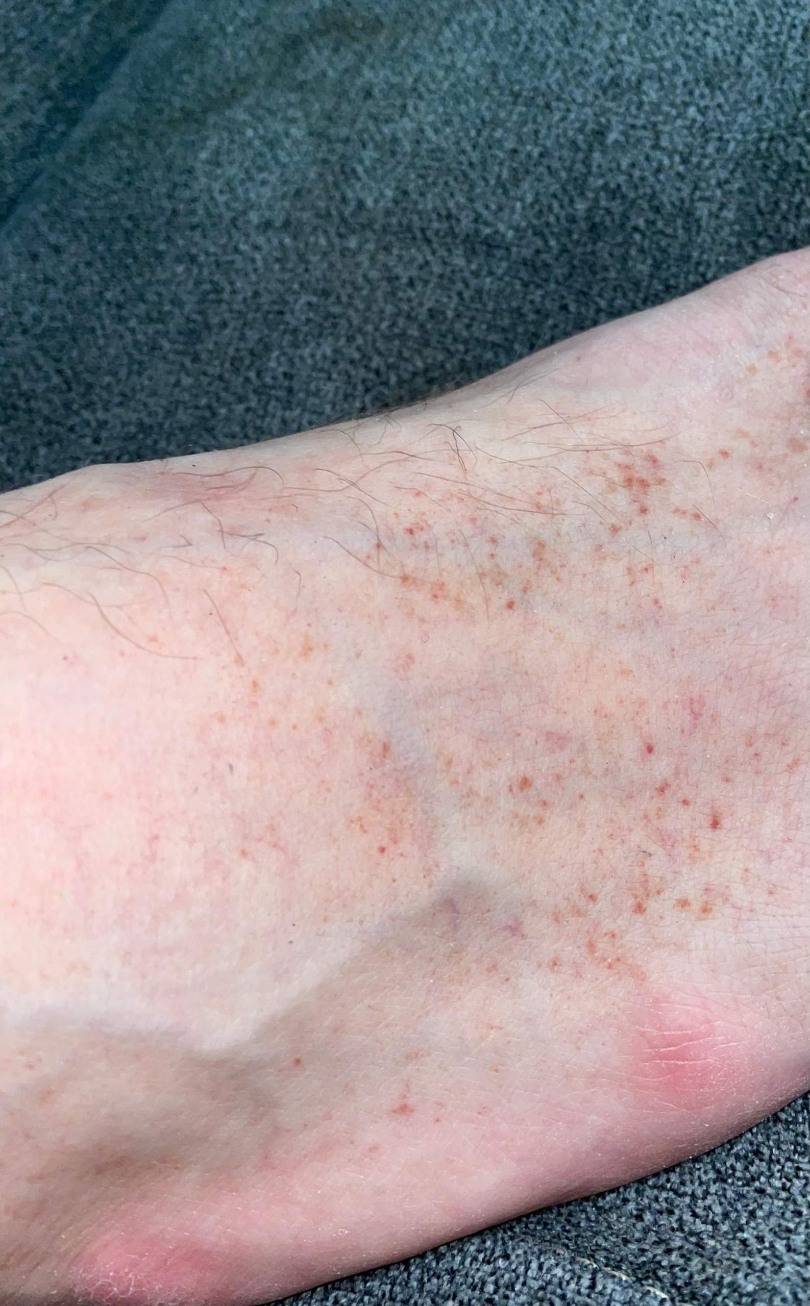 Petechien gleich Leukämie? (Gesundheit und Medizin)