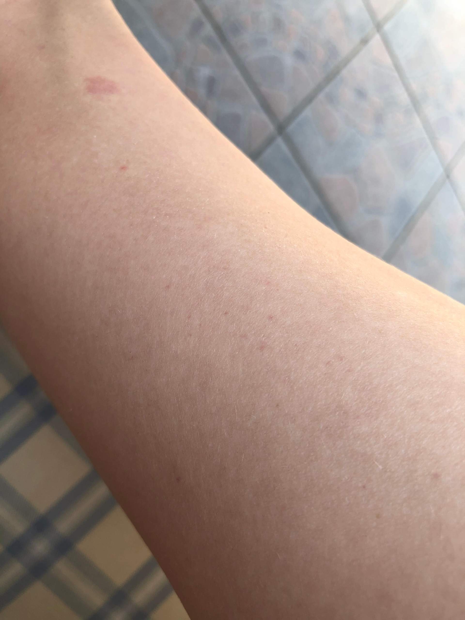 Petechien?zum Arzt? (Angst vor Krankheit)