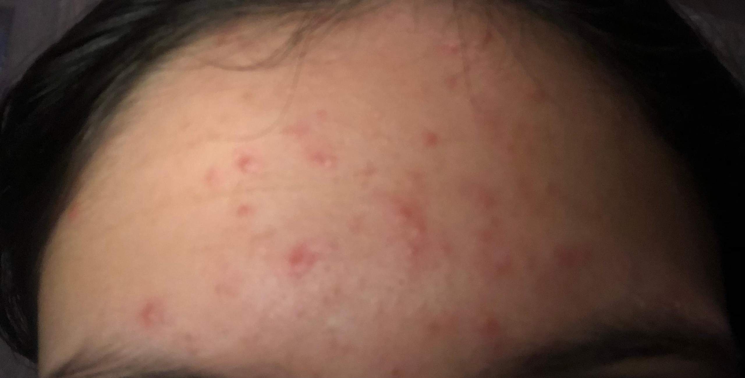 Pickel? (Haut, Pflege, Gesicht)