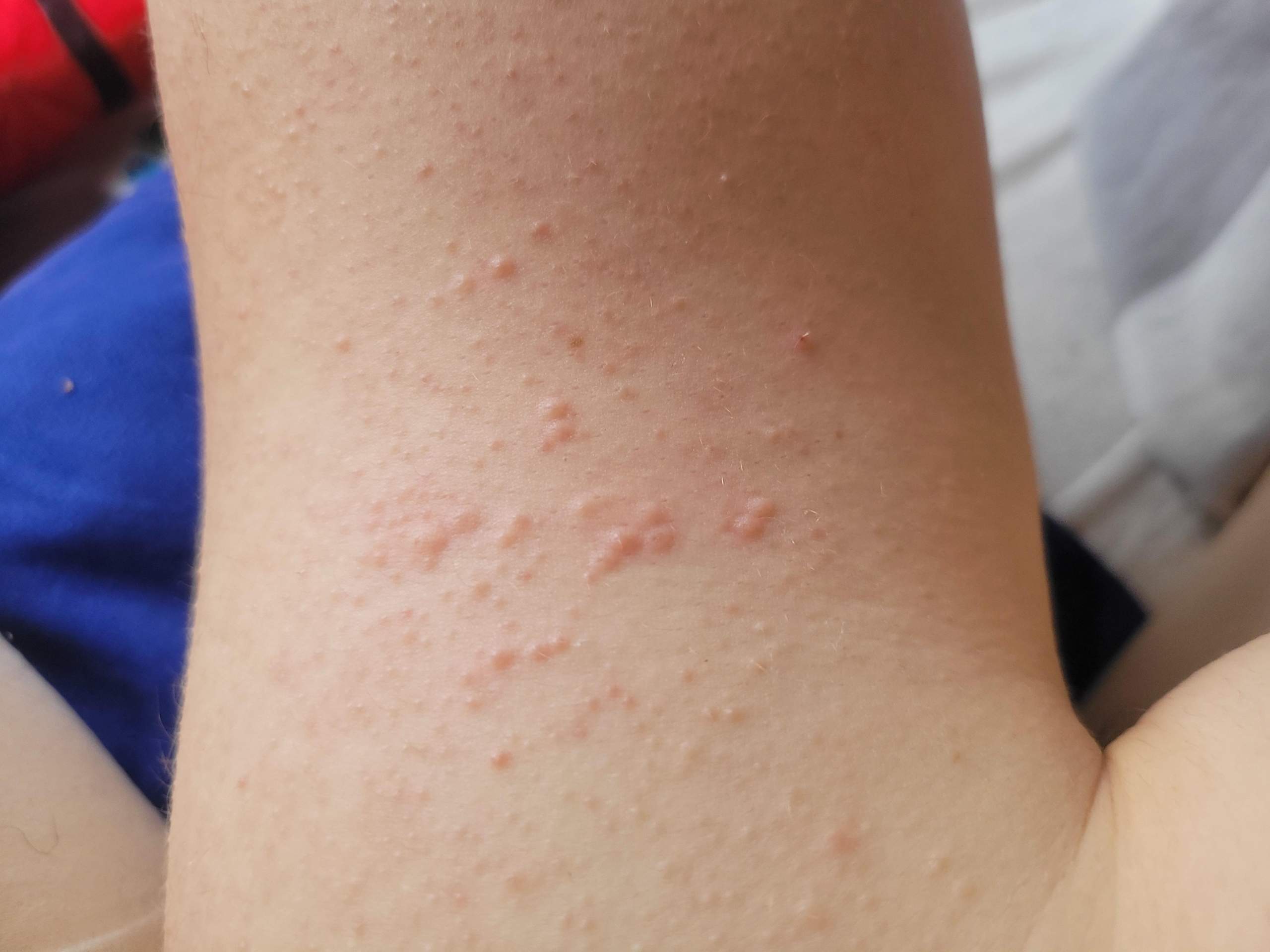 Pickel am arm? (Körper, Haut, Hautarzt)