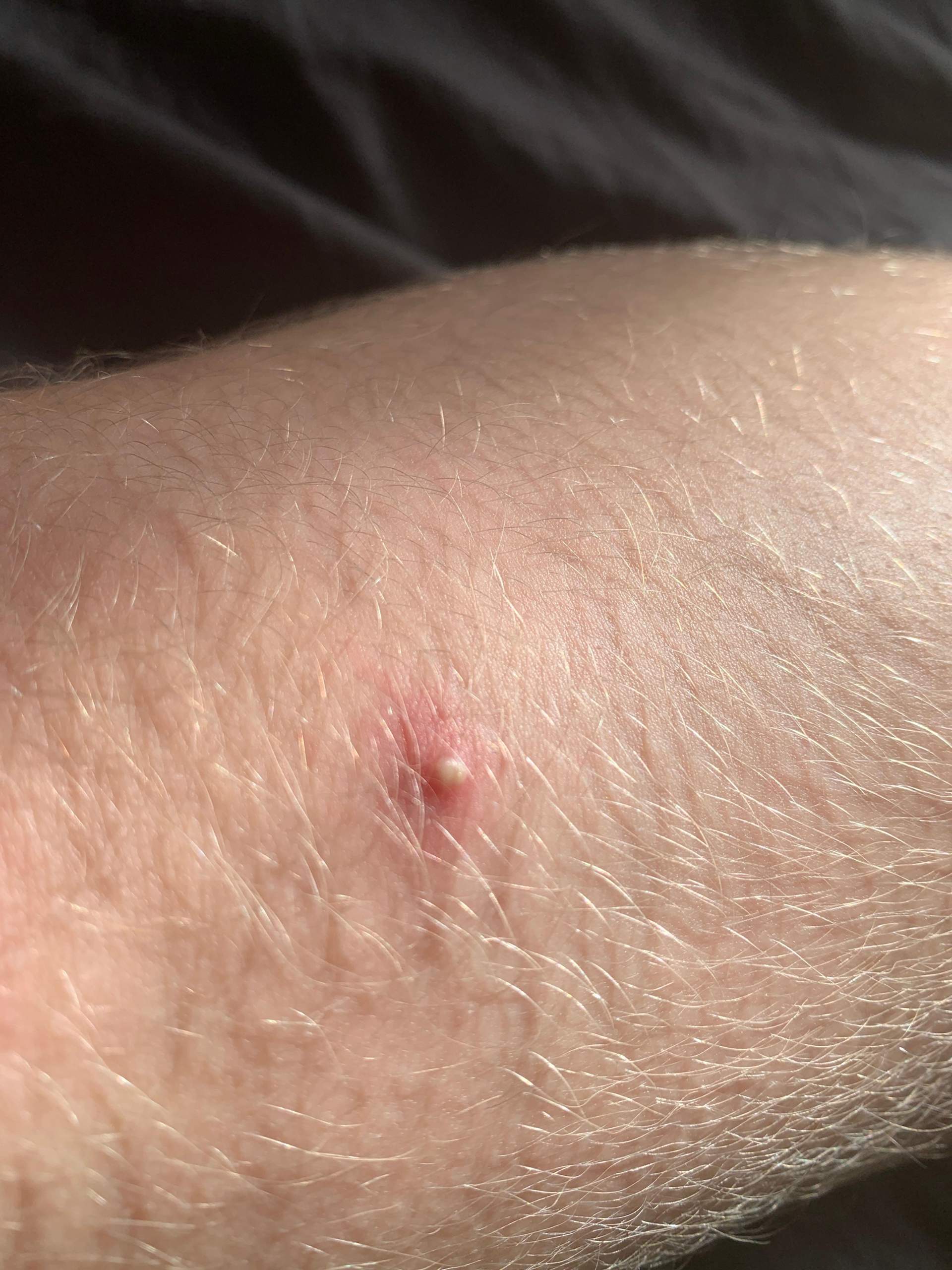 Pickel am Bein? (Haut)