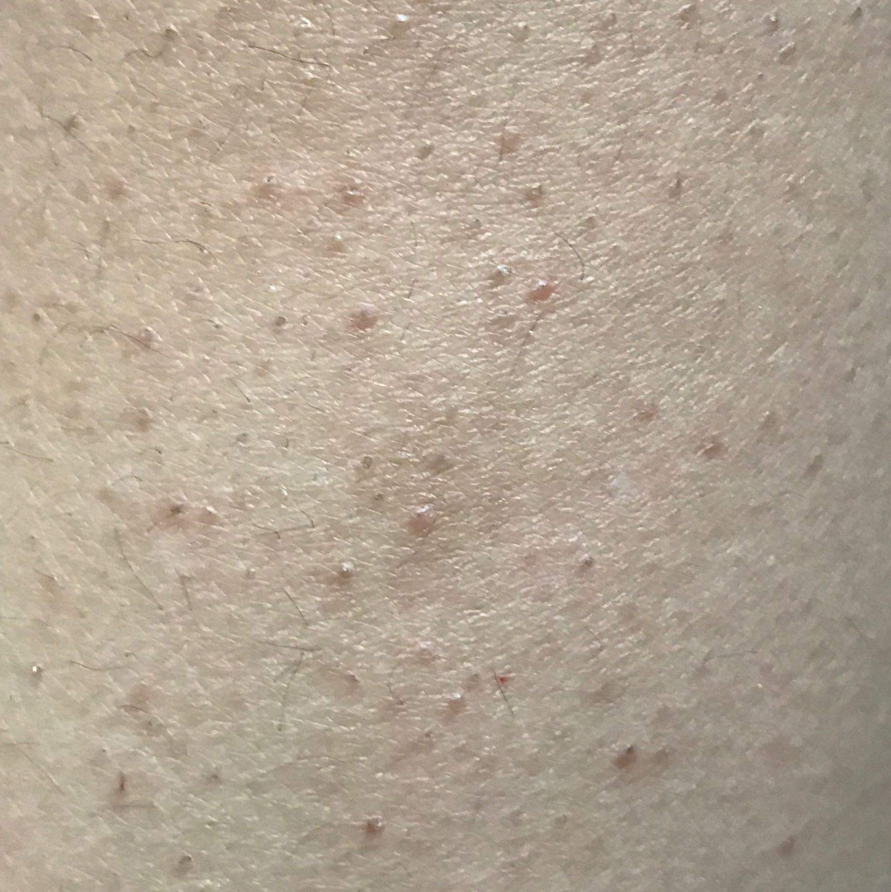 Pickel am bein oder was das? (Beine, Hygiene, Körperpflege)