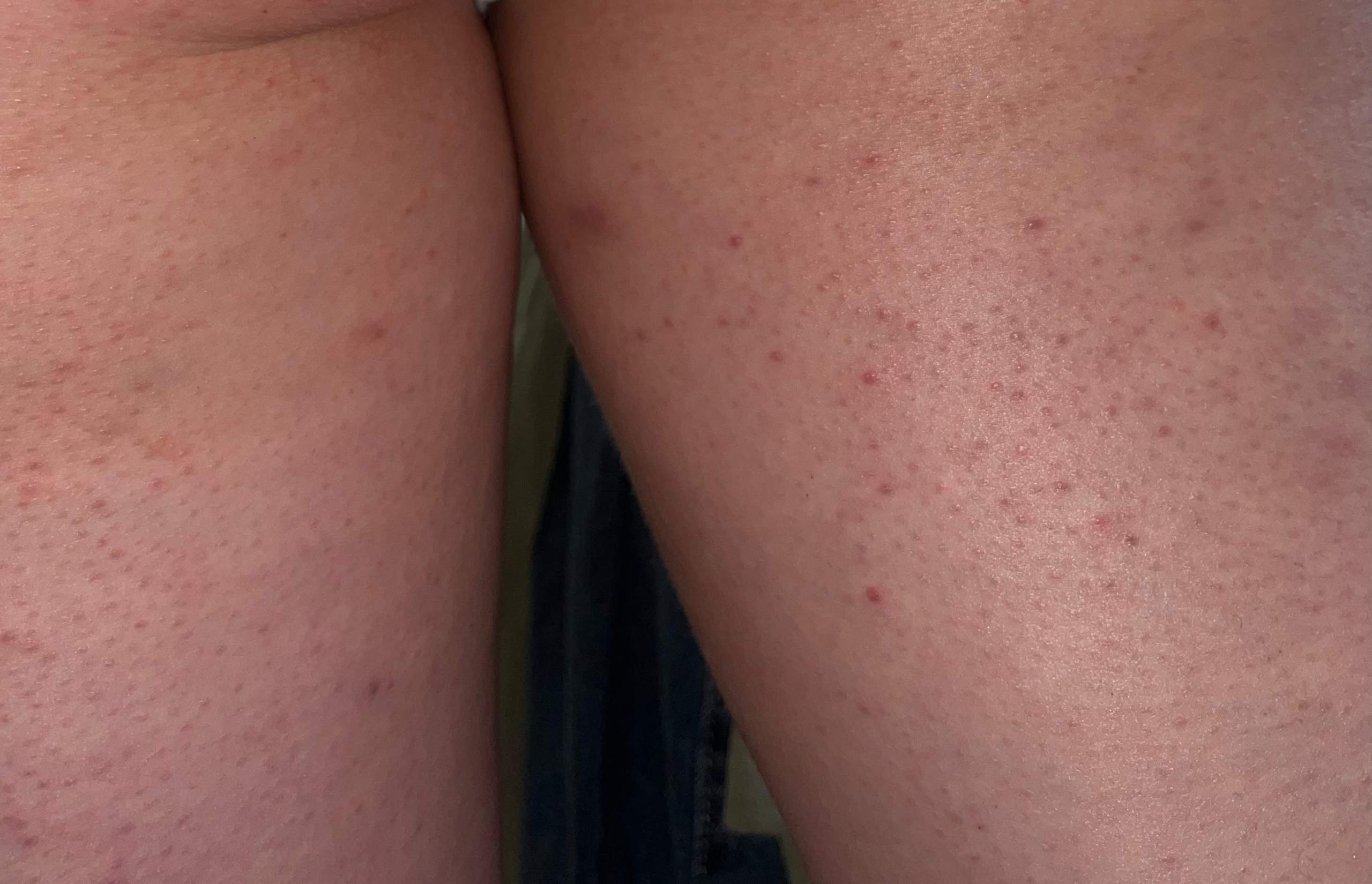 Pickel an den Beinen? (Mädchen, Körper, Haut)