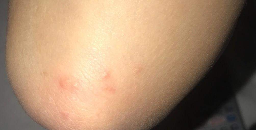 Pickel Ellenbogen? (Hautausschlag)