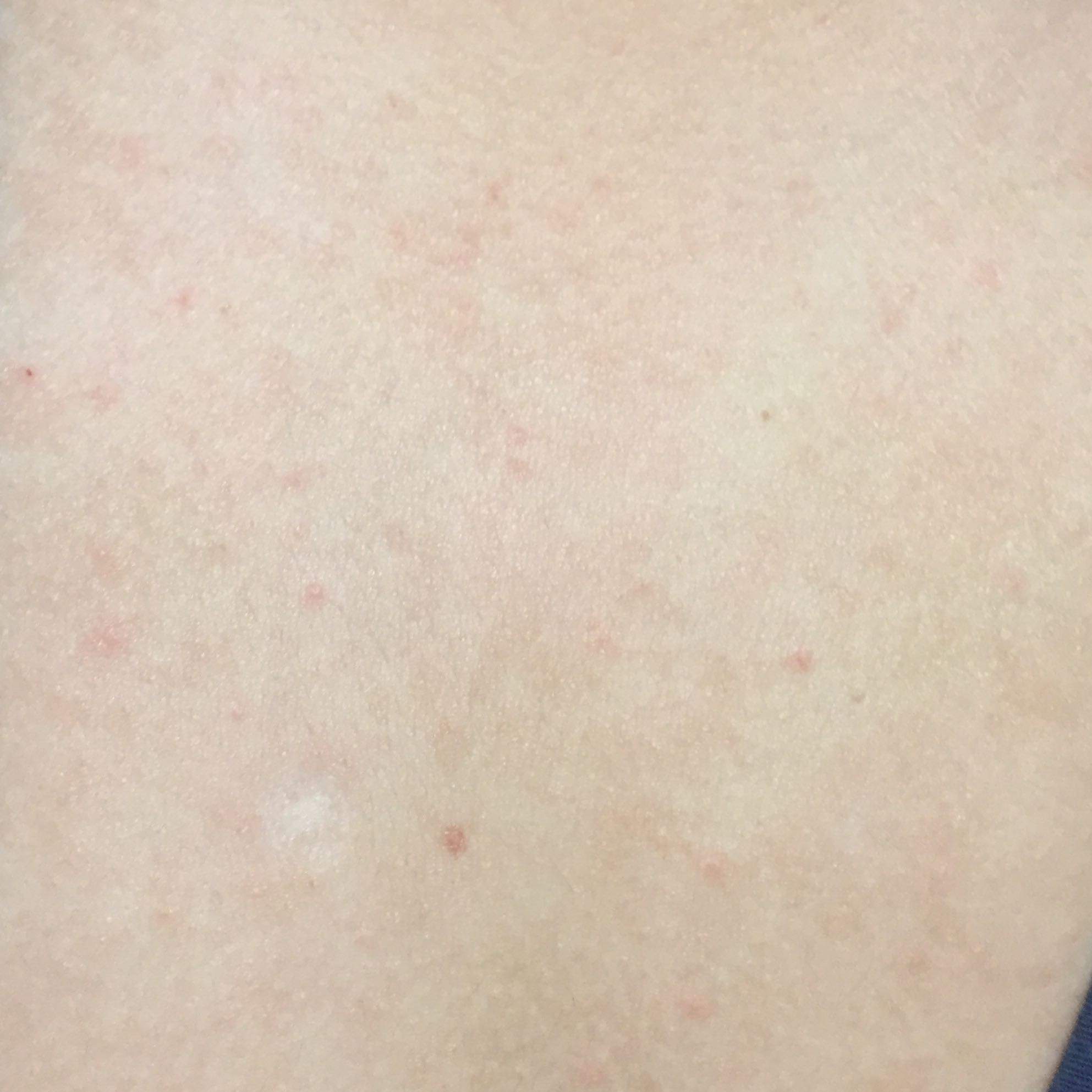 Pickelähnliche Unreinheiten auf Rücken/brust/arm? (Gesundheit und ...