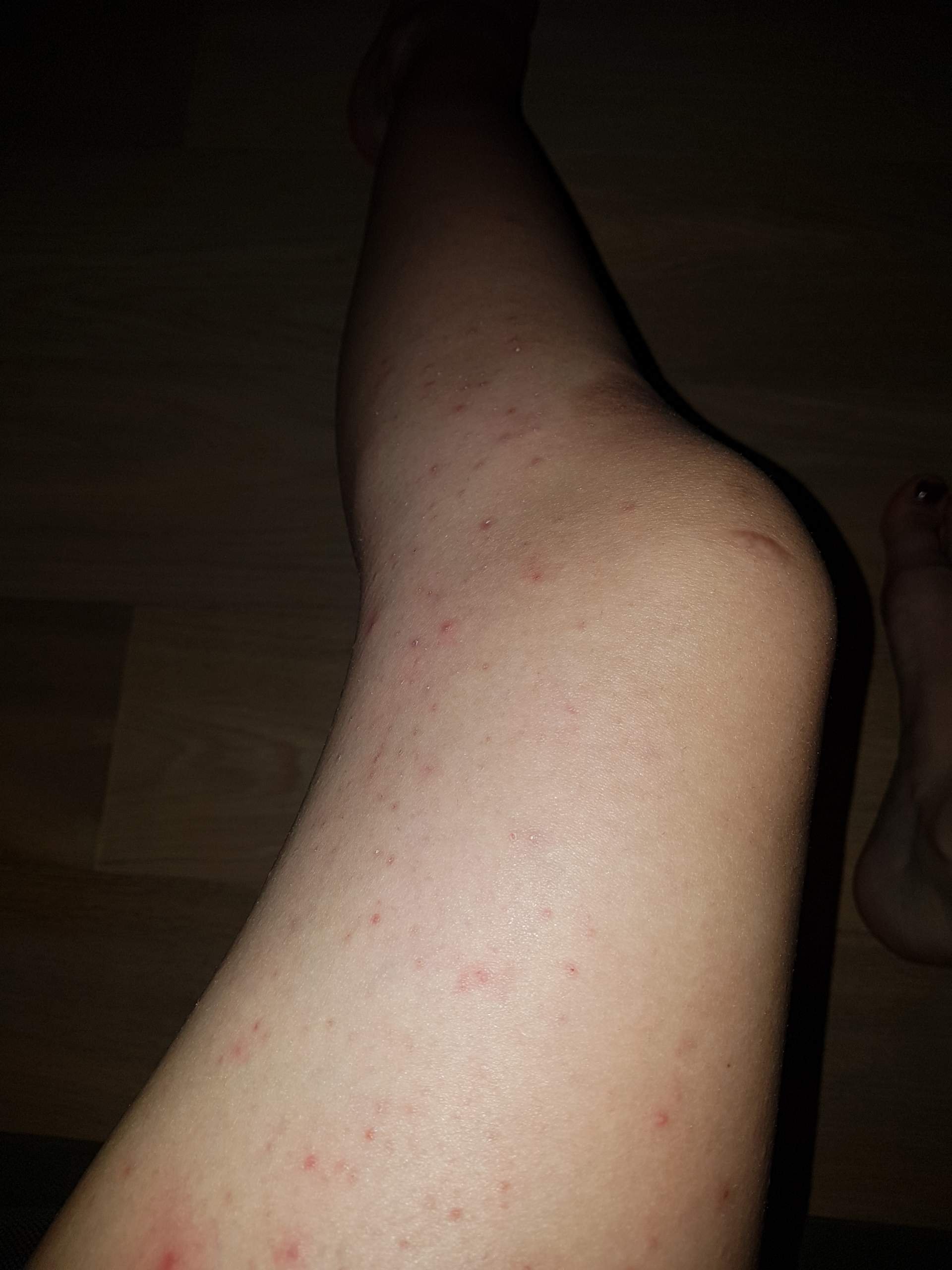 Pickelchen am linken Bein. Vom rasieren? (Haut)