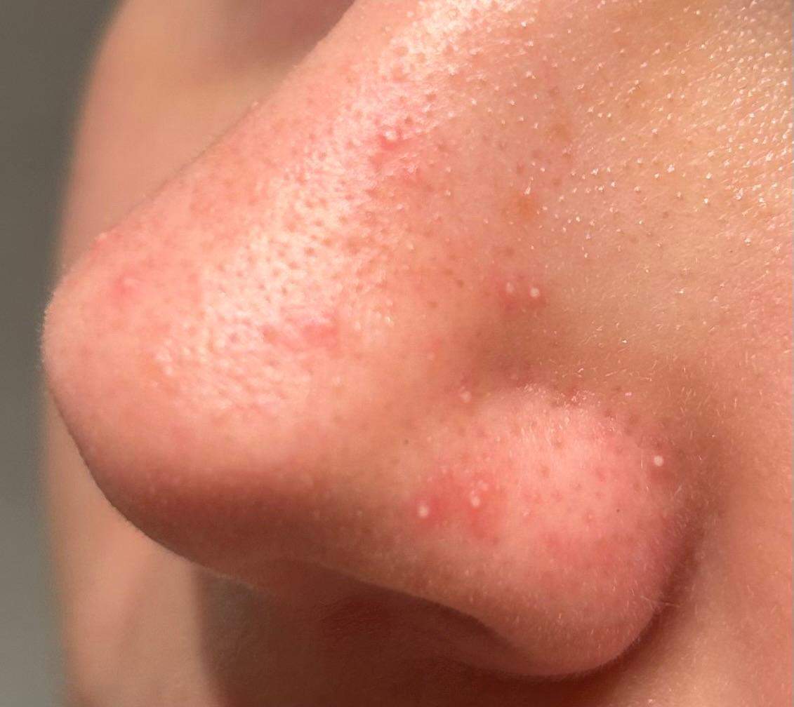 Pickelchen auf der Nase? (Haut, Pickel, Gesicht)