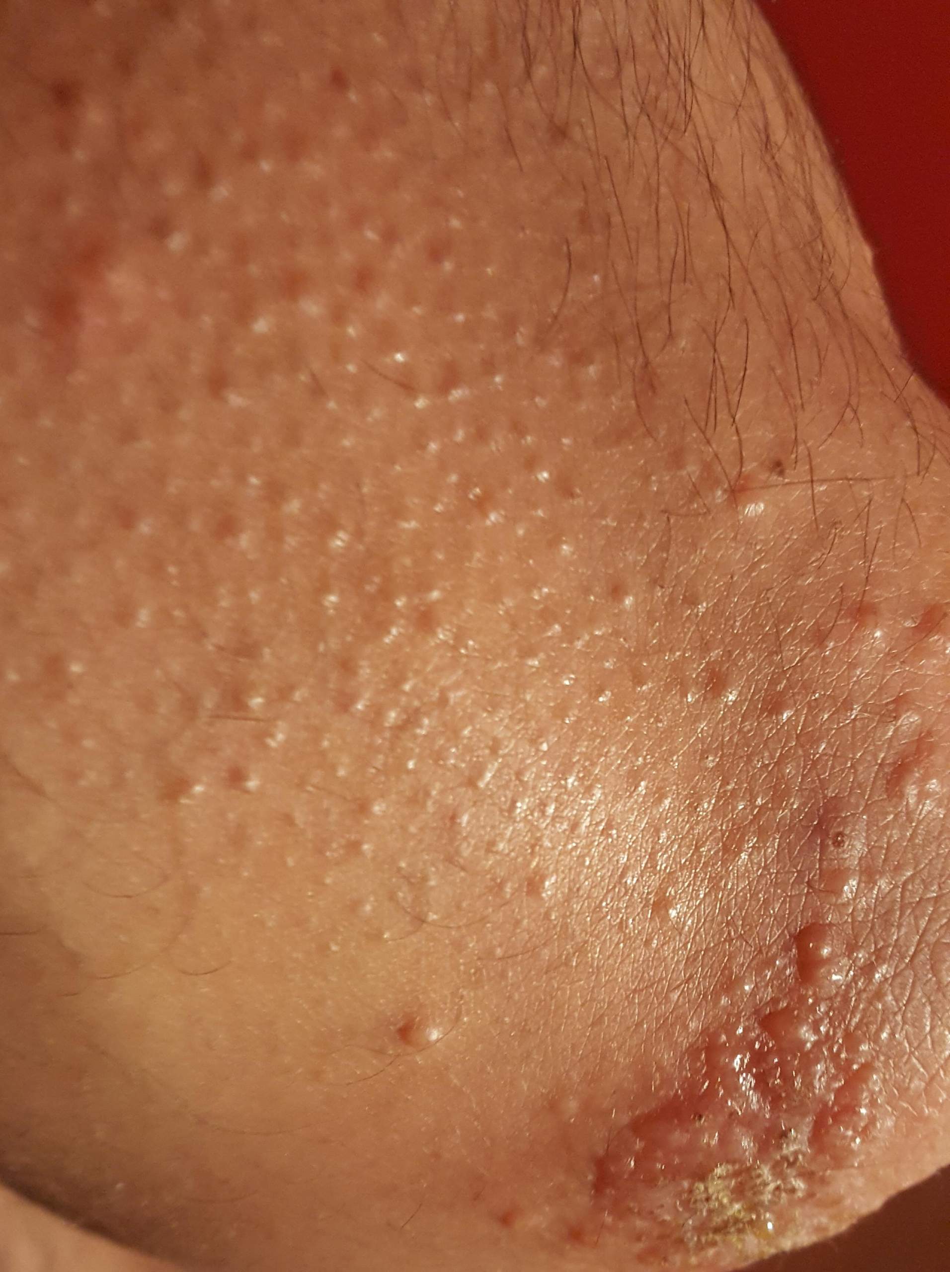 Pickel/Gänsehaut am Ellenbogen? (Gesundheit, Medizin, Krankheit)