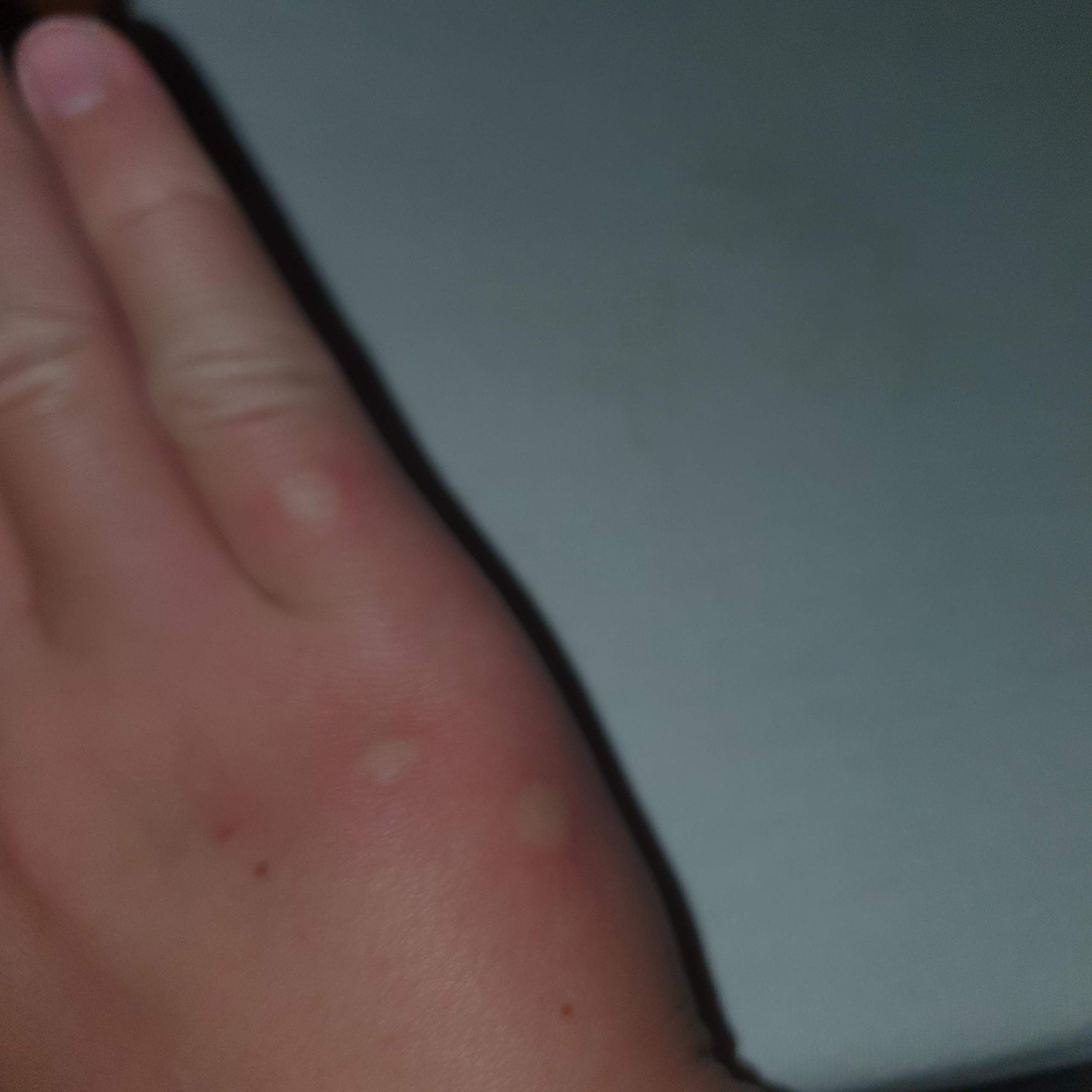 Plötzlich weiße angeschwollen Flecken an der rechten Hand? (Gesundheit ...