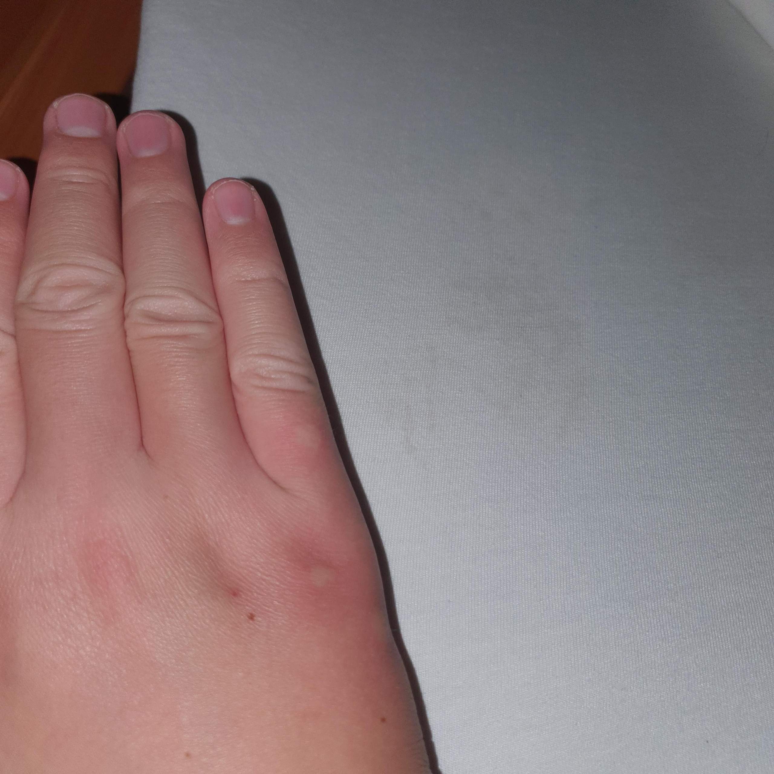 Plötzlich weiße angeschwollen Flecken an der rechten Hand? (Gesundheit ...