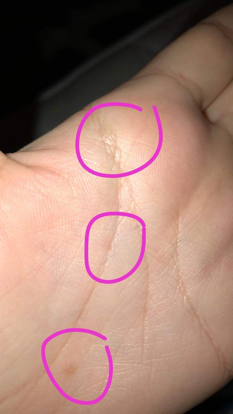 Pusteln an der Hand? (Haut)