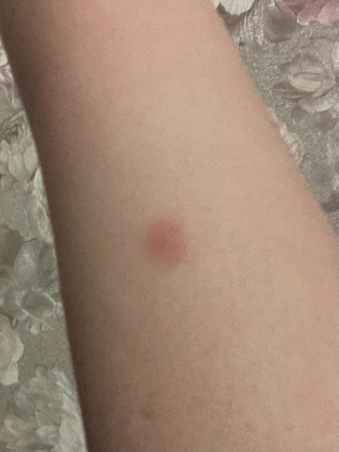 Pusteln nach Katzenkauf was soll ich tun? (Tiere, Katze, Hautprobleme)