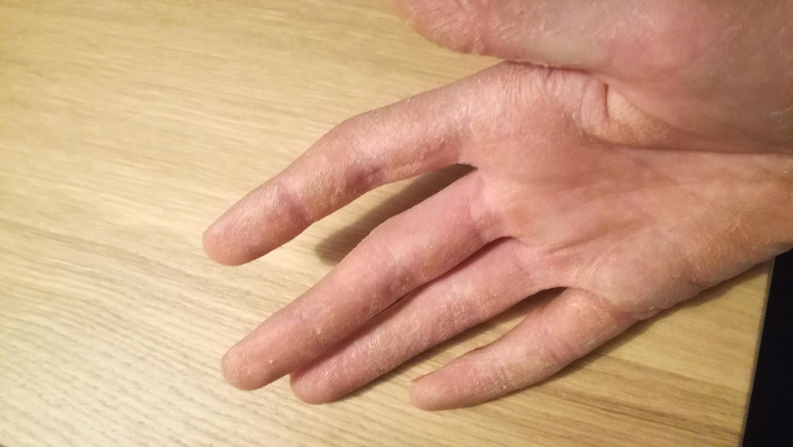 Raue Hand Gips? (Haut)