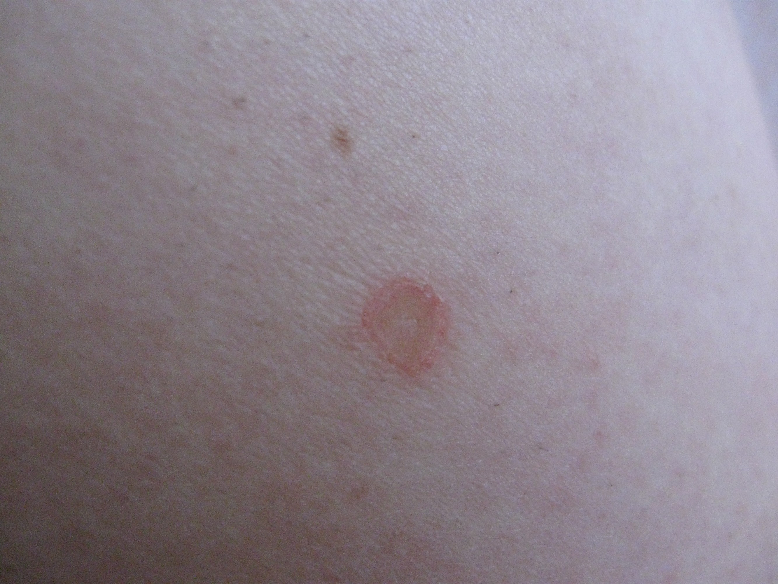 Rötlich-heller Hautfleck - was ist das? (Haut, Krebs, Flecken)