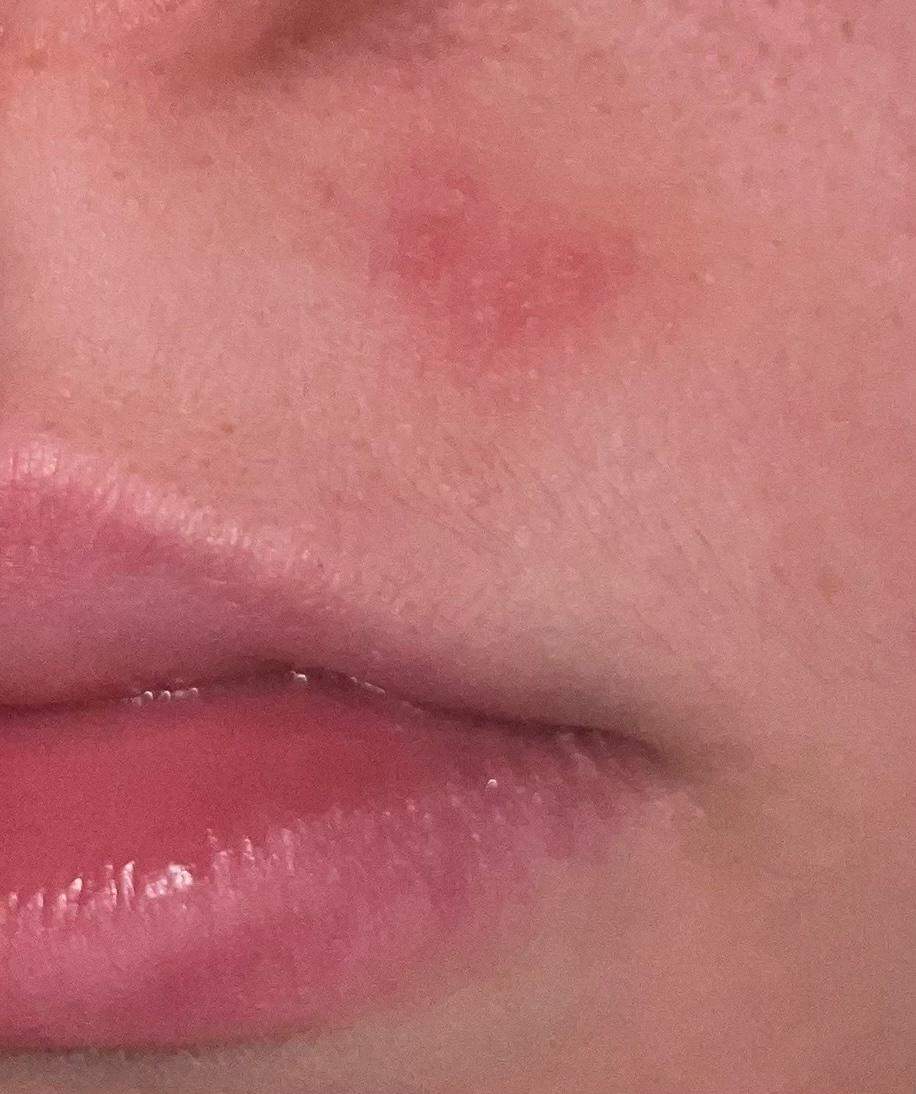 Rötung/Pickel wegbekommen? (Gesundheit und Medizin, Gesundheit, Haut)