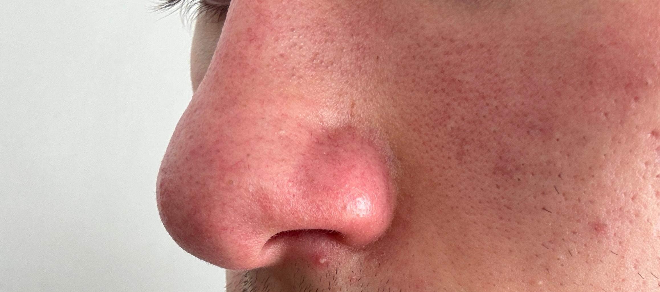 Rosacea oder Couperose? (Haut, Pickel, Gesicht)