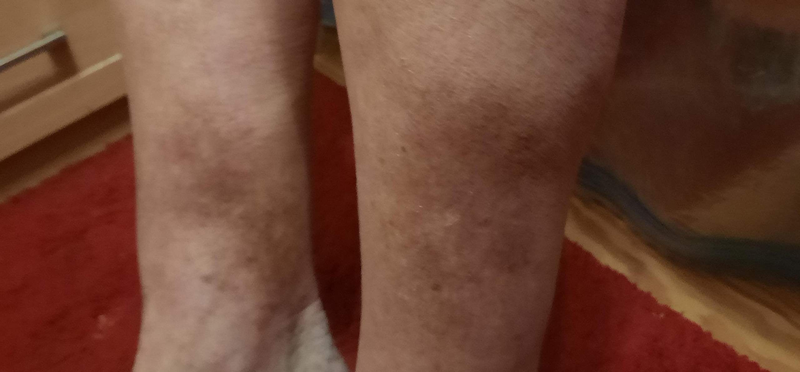 Rote Flecken Am Bein Venenschwäche