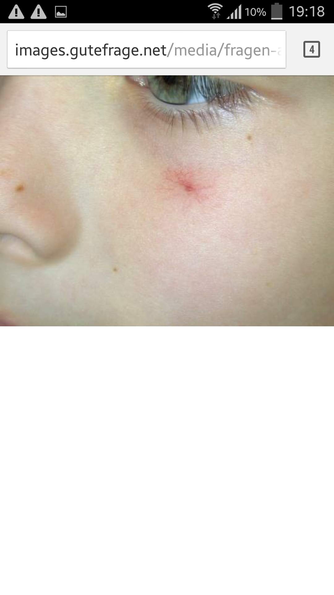 Rote, geplatzte Ader im Gesicht ( Teleangiektasien ) HILFE (Gesundheit ...