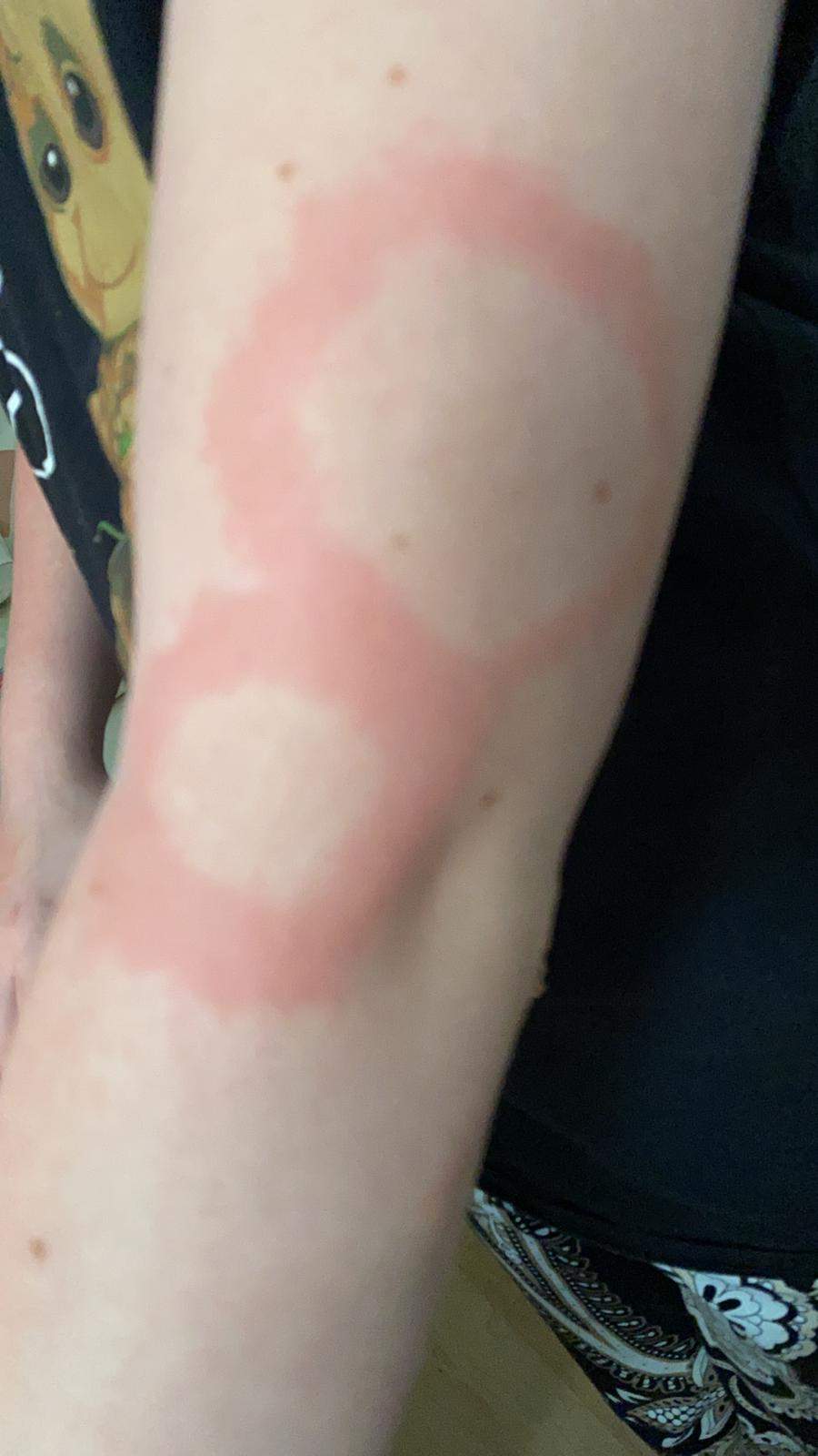 Rote kreise unter der Haut? (Gesundheit und Medizin, Krankheit, krank)