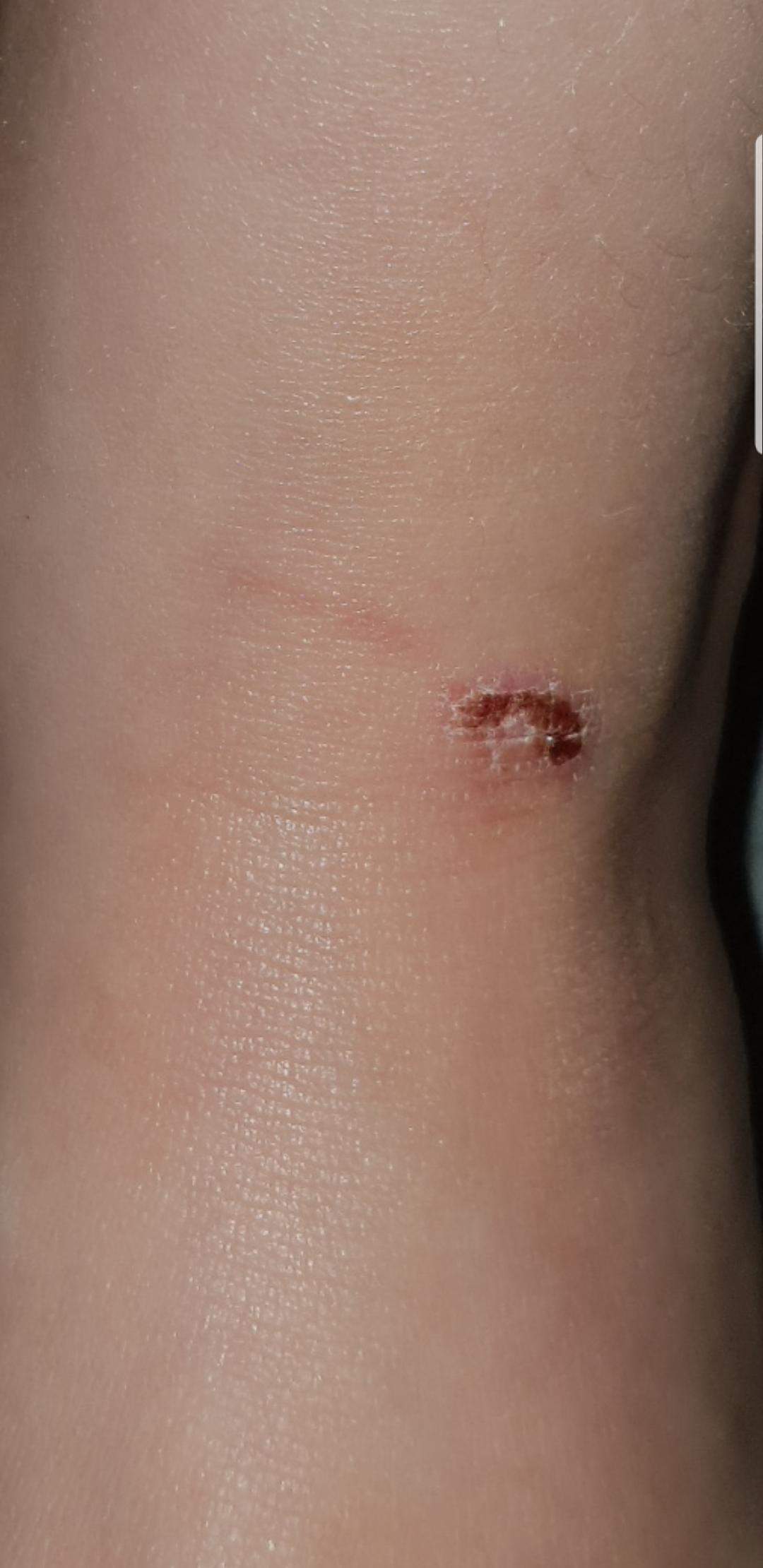 Rote Linie - Blutvergiftung? (Computer, Blutvergiftungsgefahr)