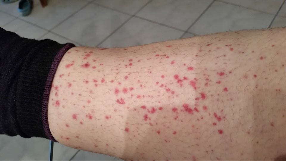 Rote Punkte an den Unterschenkeln (Krankheit, Hautkrankheit)