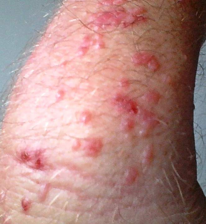 Rote Pusteln an Händen und Unterarmen? (Gesundheit und Medizin, Haut ...