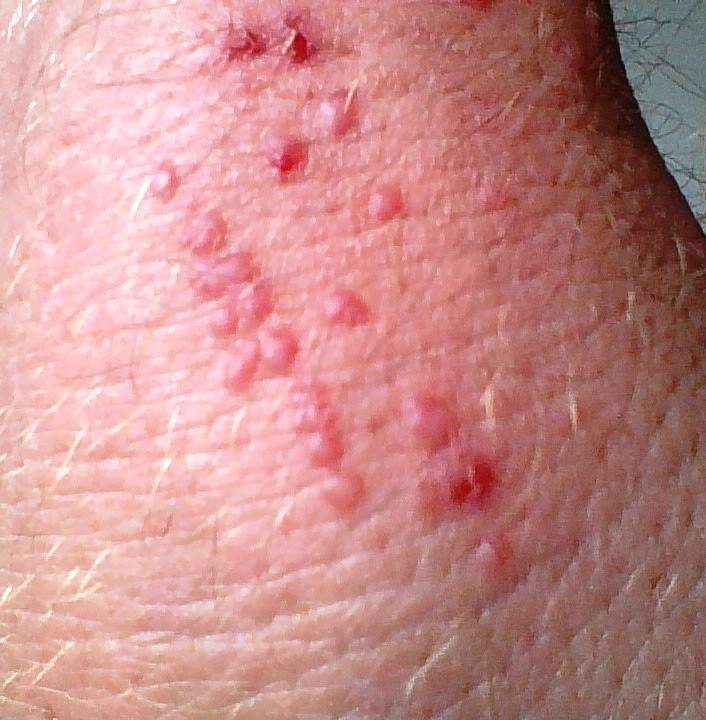 Rote Pusteln an Händen und Unterarmen? (Gesundheit und Medizin, Haut ...