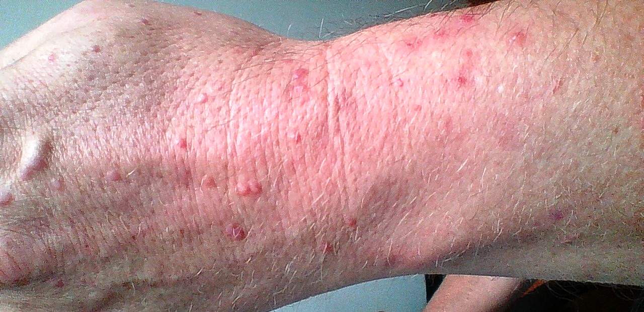 Rote Pusteln an Händen und Unterarmen? (Gesundheit und Medizin, Haut ...
