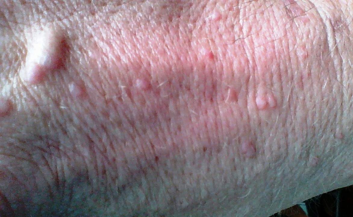 Rote Pusteln an Händen und Unterarmen? (Gesundheit und Medizin, Haut ...