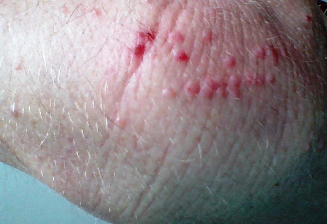 Rote Pusteln an Händen und Unterarmen? (Gesundheit und Medizin, Haut ...