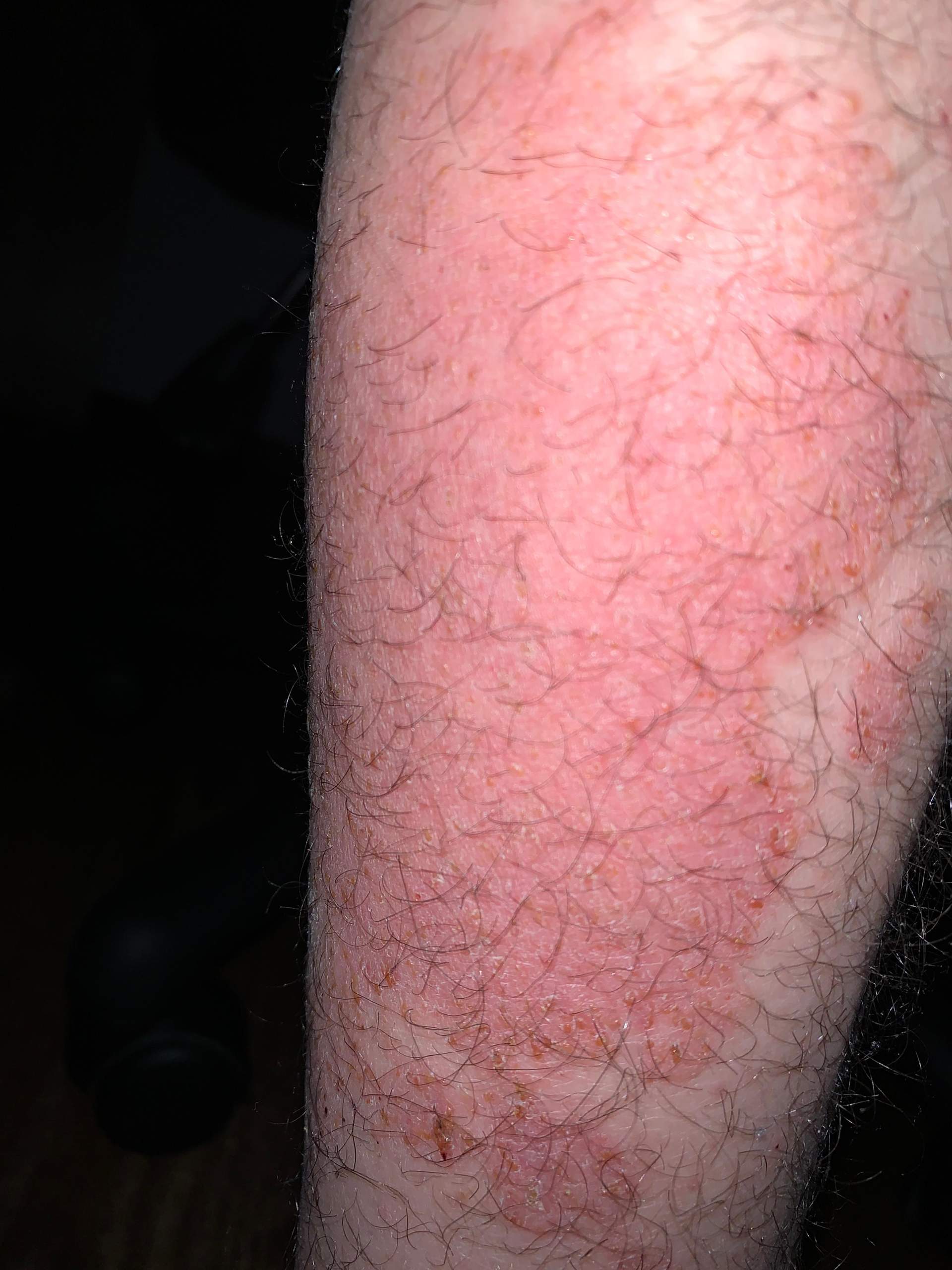 Roter Fleck? (Gesundheit und Medizin, Haut)