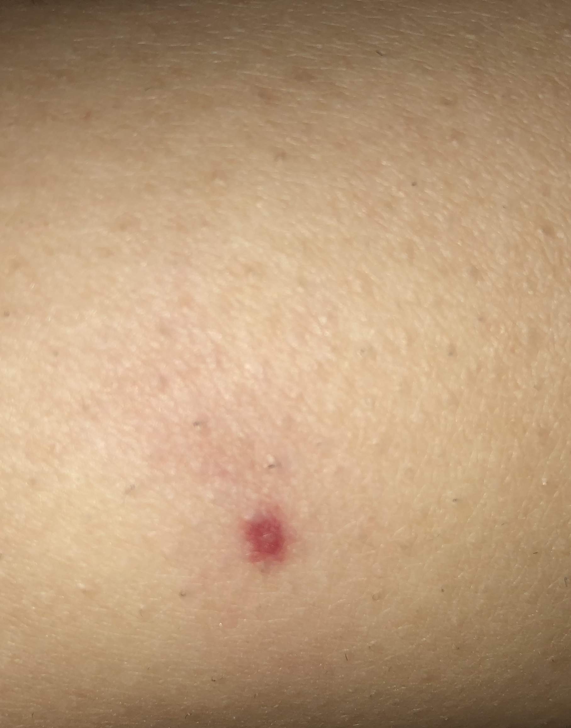 Roter Fleck auf dem Bein. Was ist das? (Krankheit, Beine)