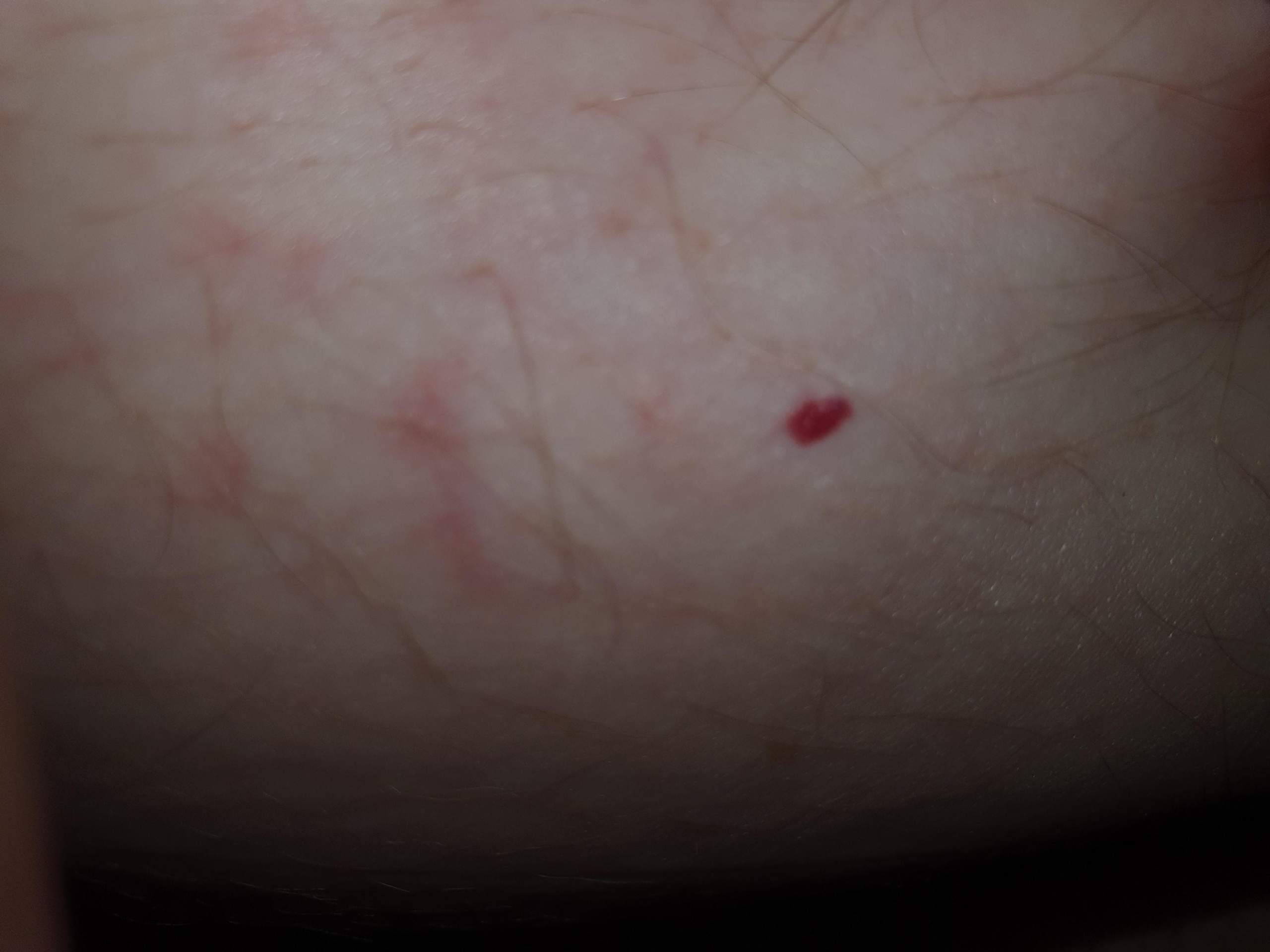 Roter Hautkrebs? (Krebs)