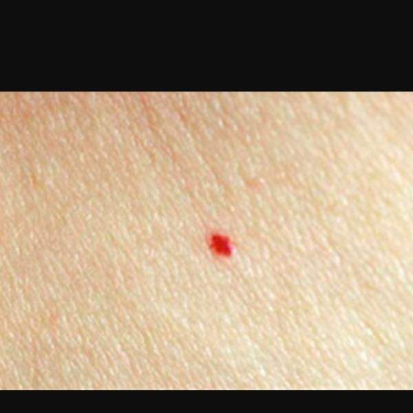 Roter Punkt auf Brust? (Gesundheit, Menschen, Krankheit)