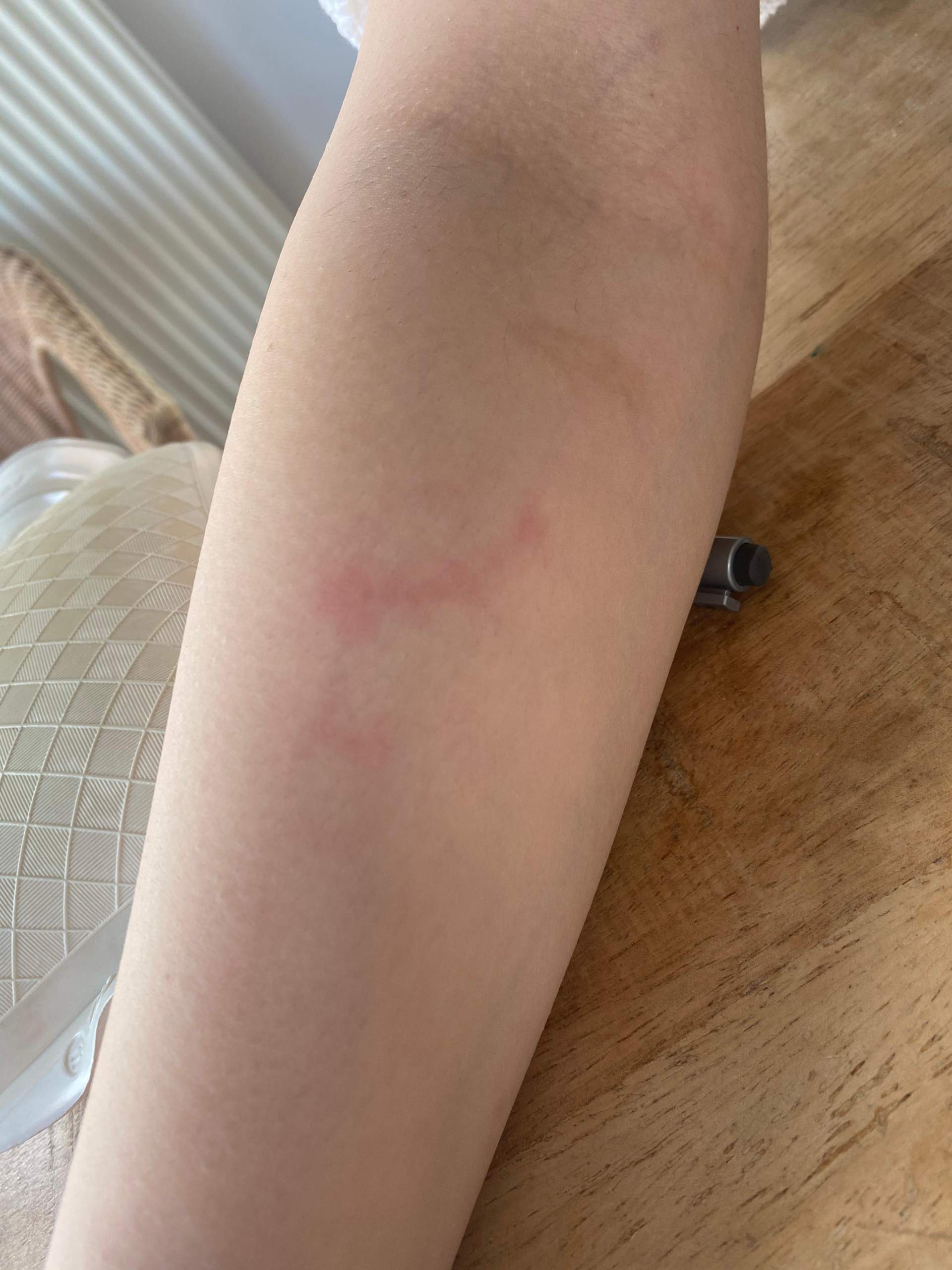 Roter Streifen / Fleck an meinem Arm, weiß jemand was das sein könnte ...