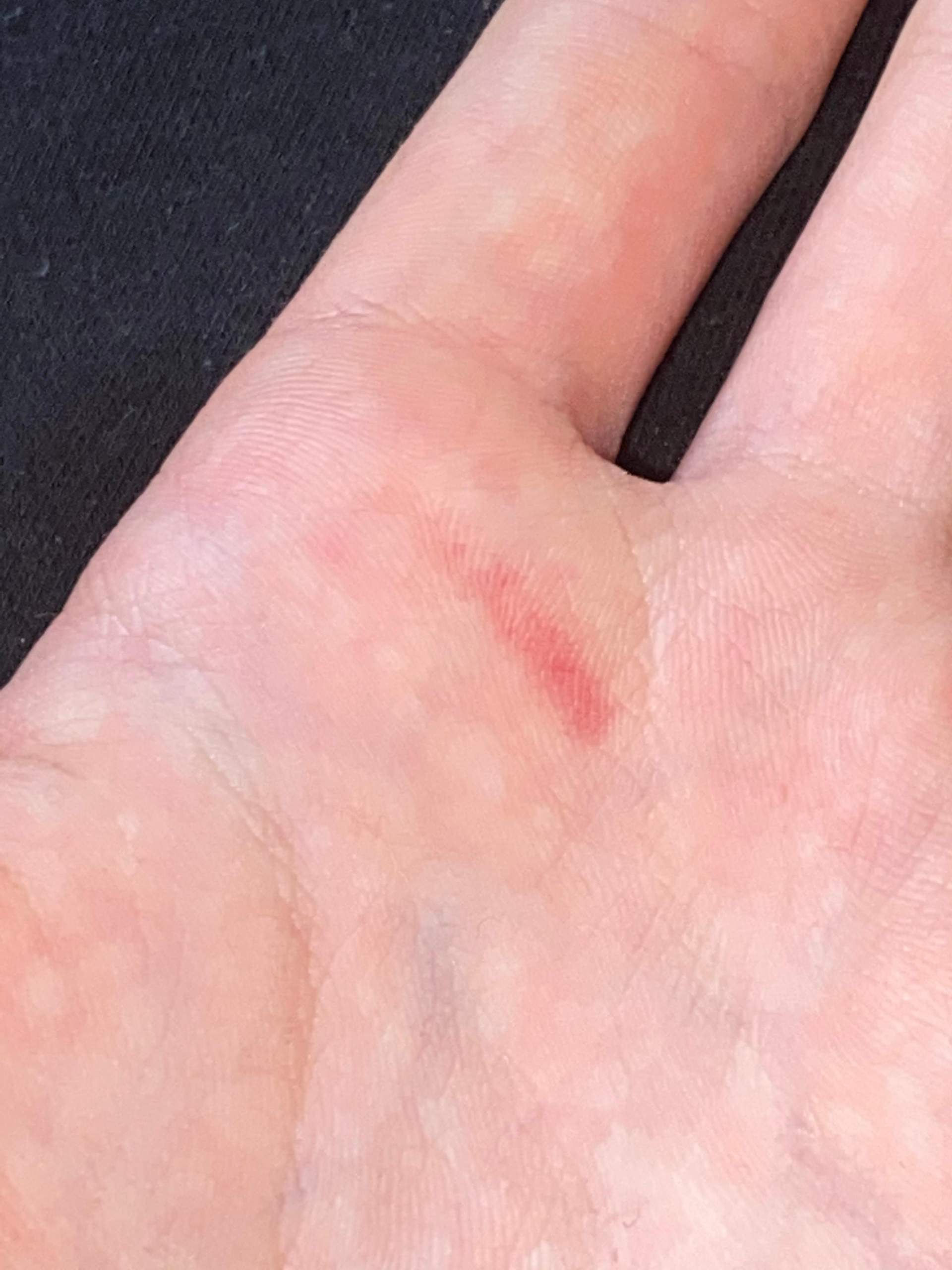 Roter Strich auf der Handfläche? (Gesundheit und Medizin, Gesundheit, Haut) Roter Strich auf der Handfläche? (Gesundheit und Medizin, Gesundheit, Haut)