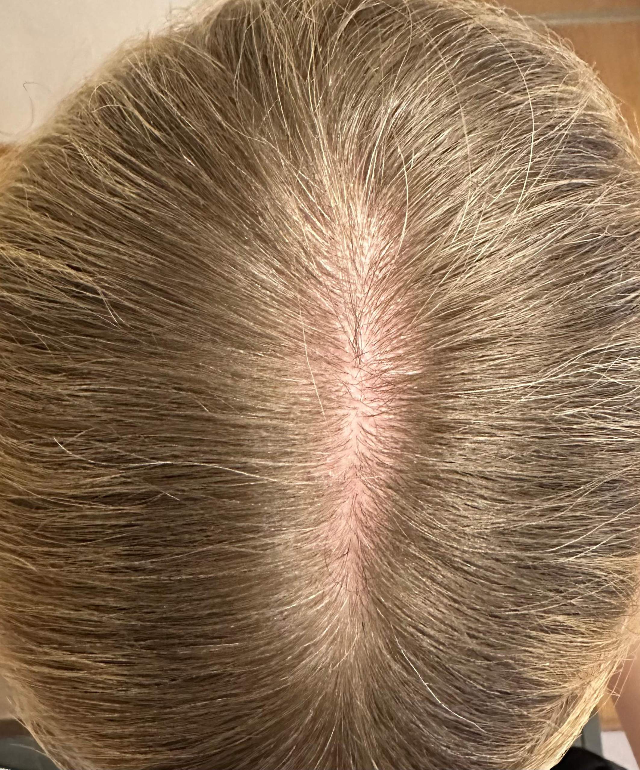 Scheitel normal oder doch Hasrausfall? (Mädchen, Gesundheit, Haarausfall)