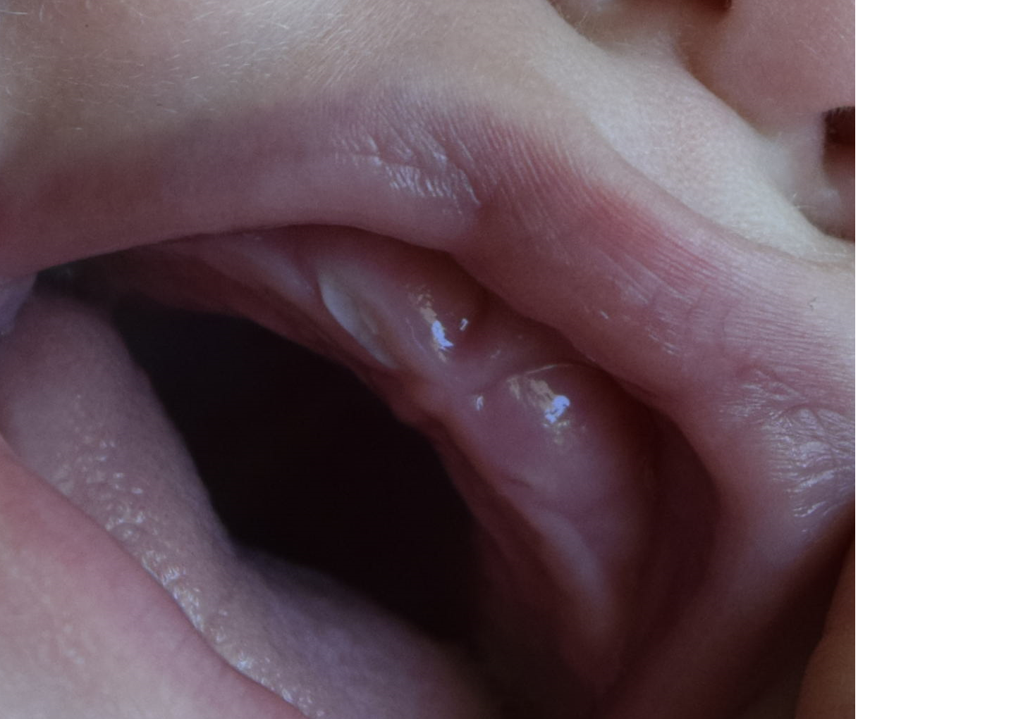 Schneidezahn doppelt? (Zähne)