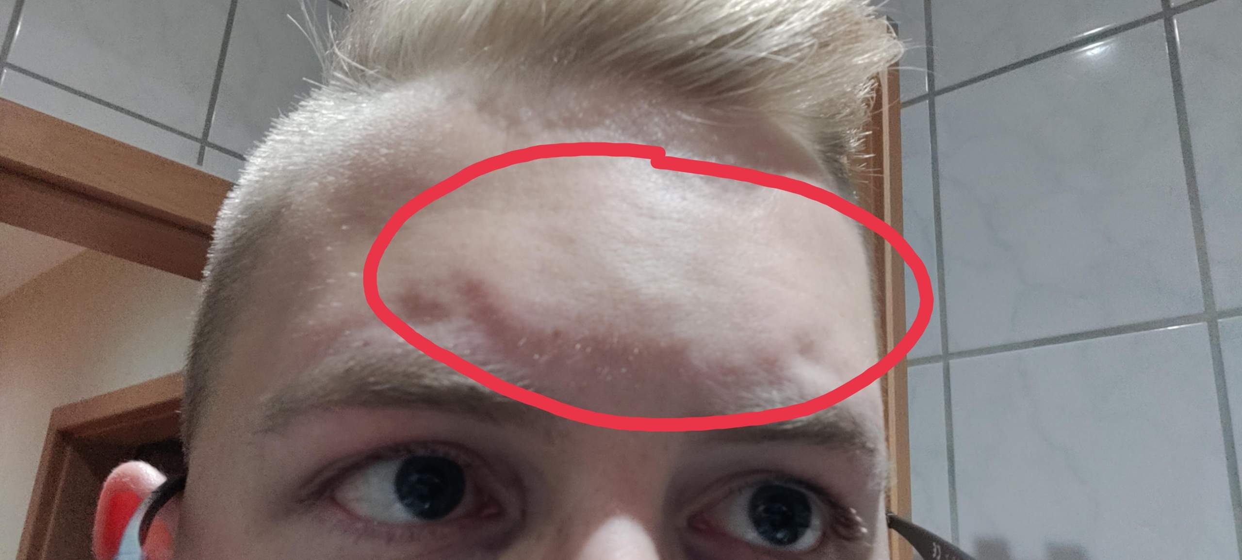 Schwellung an Stirn, Wasser? (Haut)