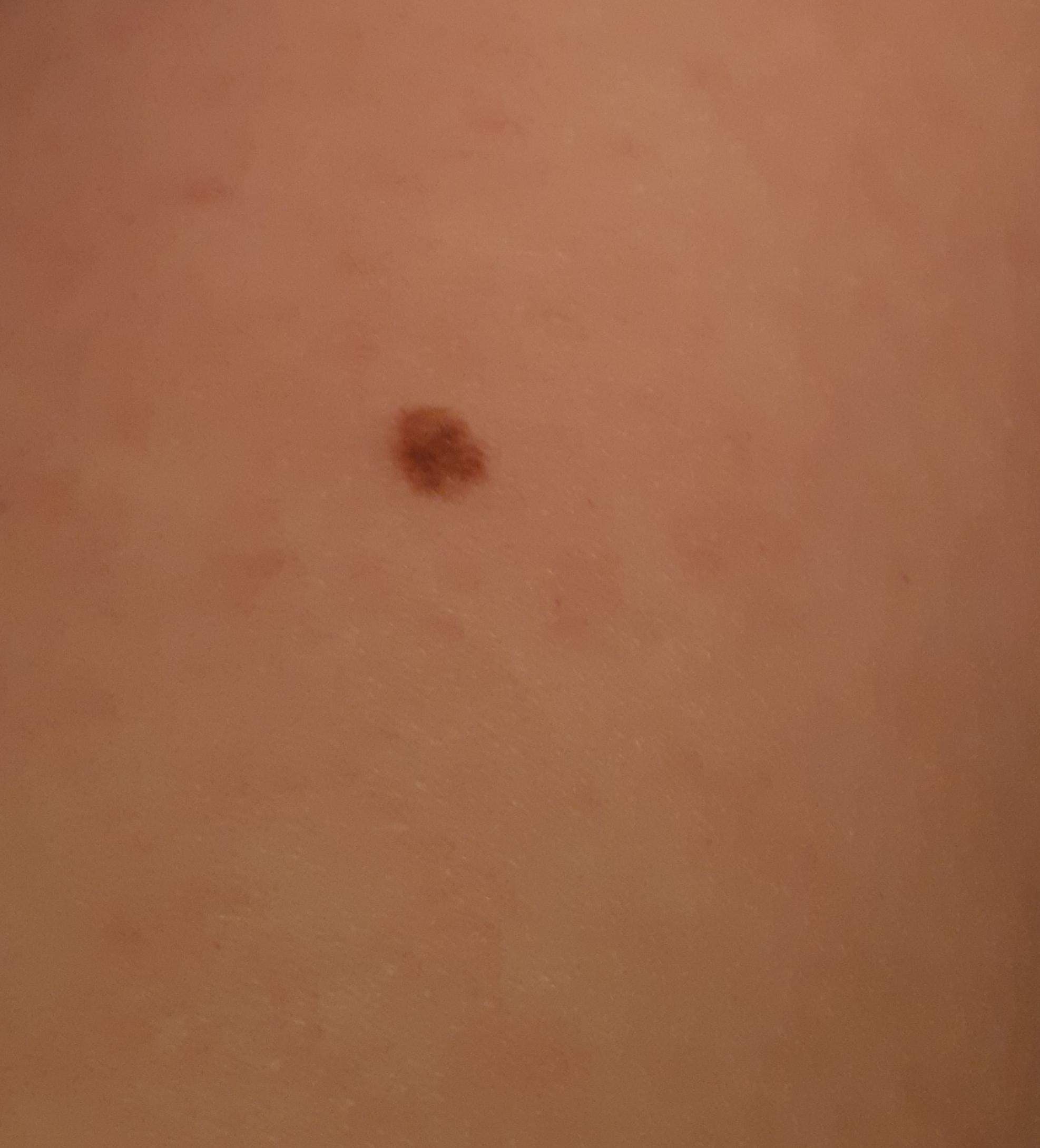 Sehen meine Muttermale noch ,,gesund" aus? (Hautarzt, Muttermal)