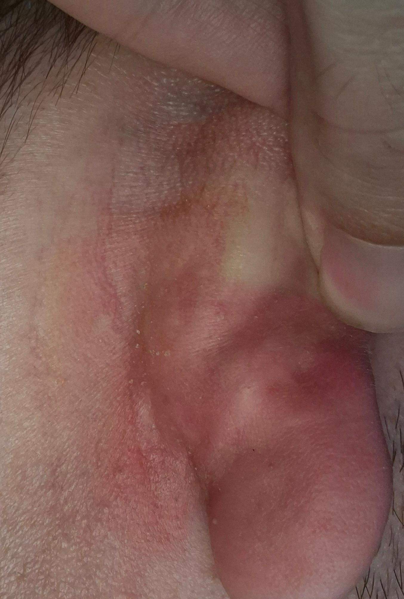 Sieht das gefährlich aus am Ohr? (Gesundheit, Menschen, Leben)