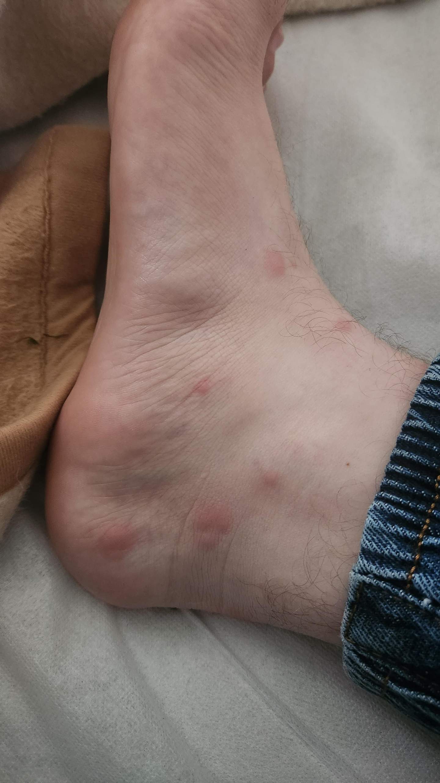 Sind das Bettwanzenbisse? (Medizin, Insekten, Schädlinge)