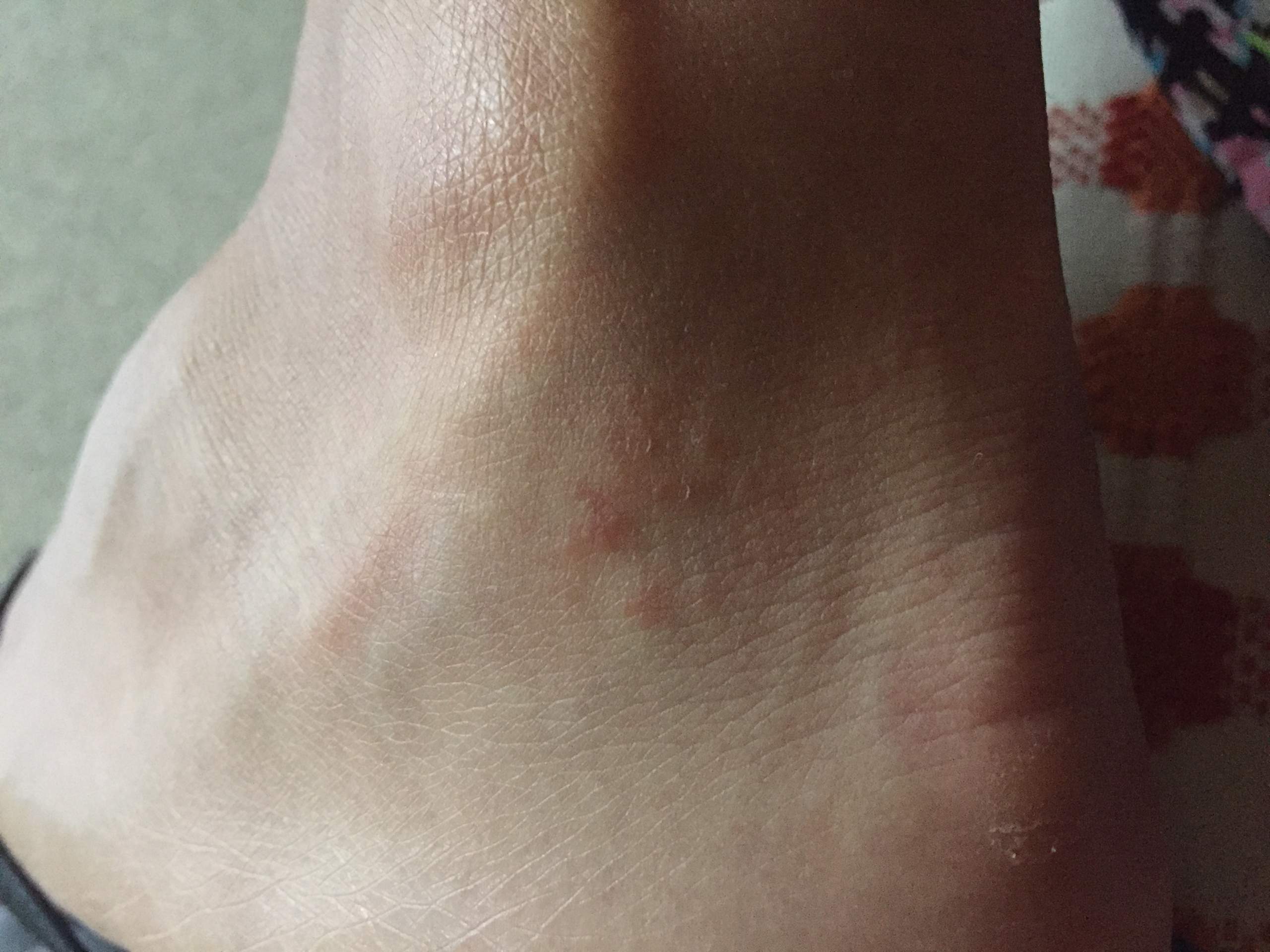 Sind das Bettwanzen und sehen so die Stiche aus? (Gesundheit, Tiere, Stich)