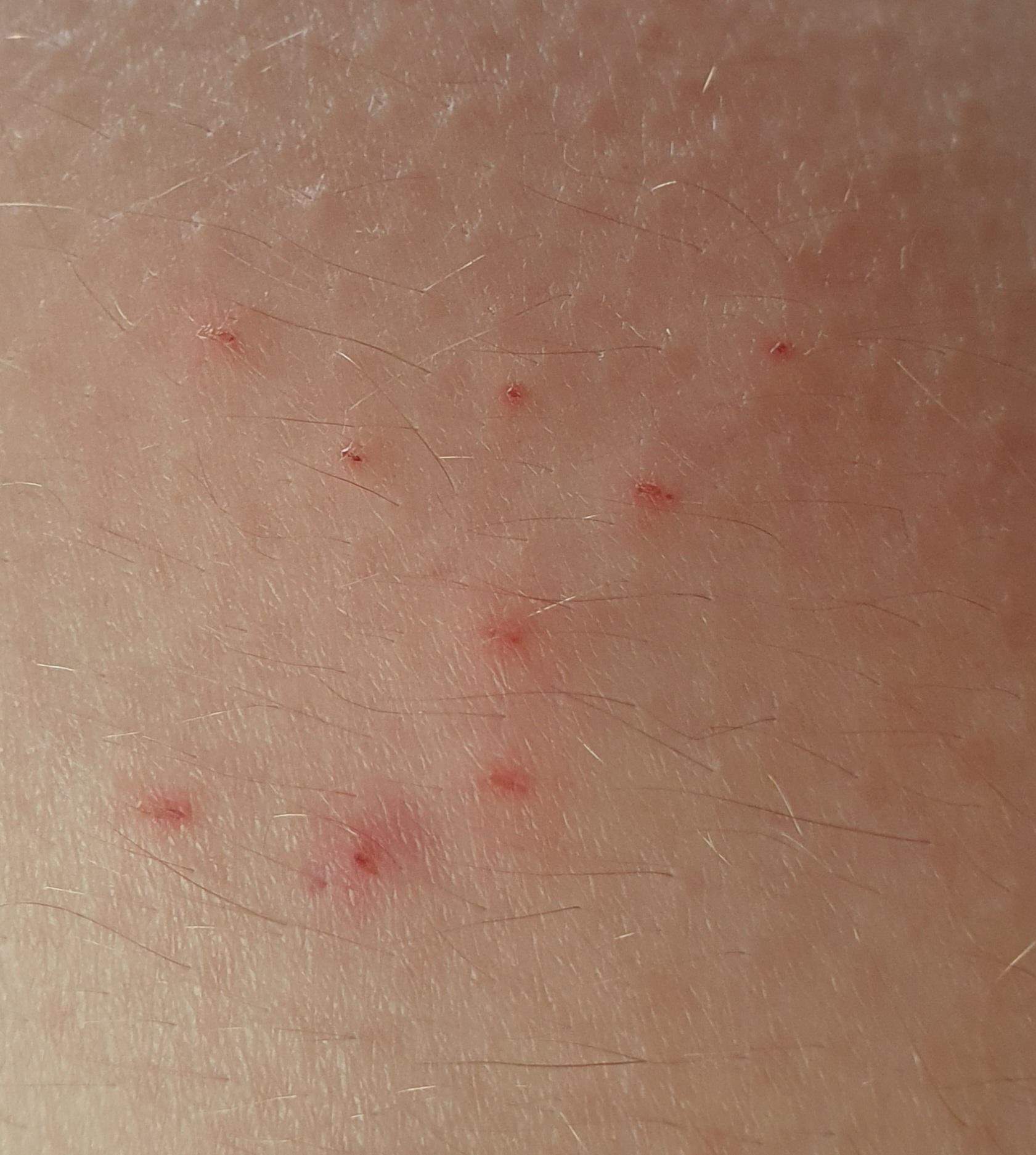 Sind das da Bettwanzen Bisse? (Gesundheit, Medizin, Hygiene)