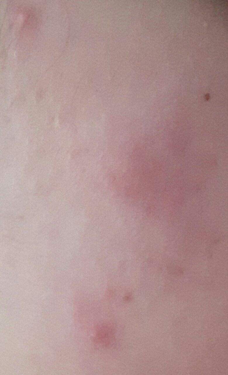 Sind das Flohstiche(mit Foto)? (Gesundheit und Medizin, Körper, Tiere)