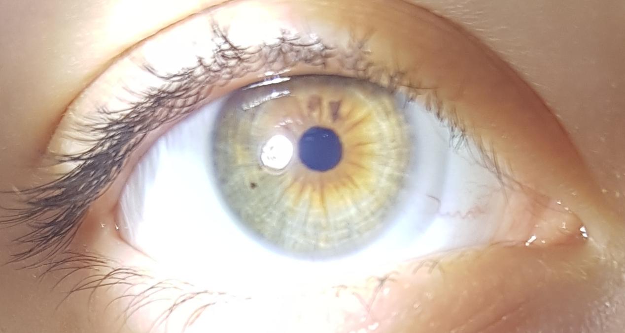 Sind das Hazel Eyes? Und ist das eine Zentrale Heterocromie? Welche ...