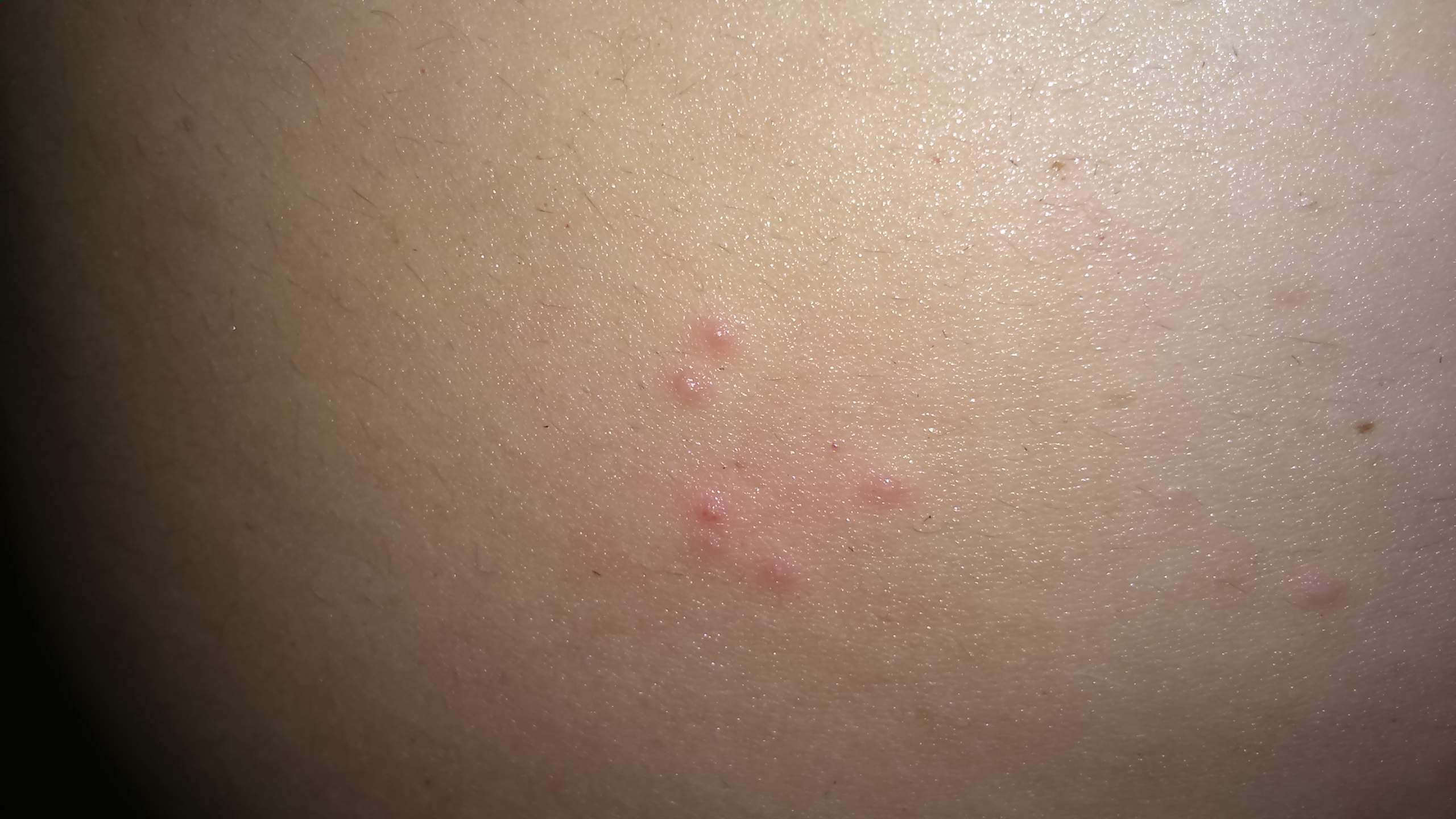 Sind das Insektenbisse? (Insekten, Immunsystem)
