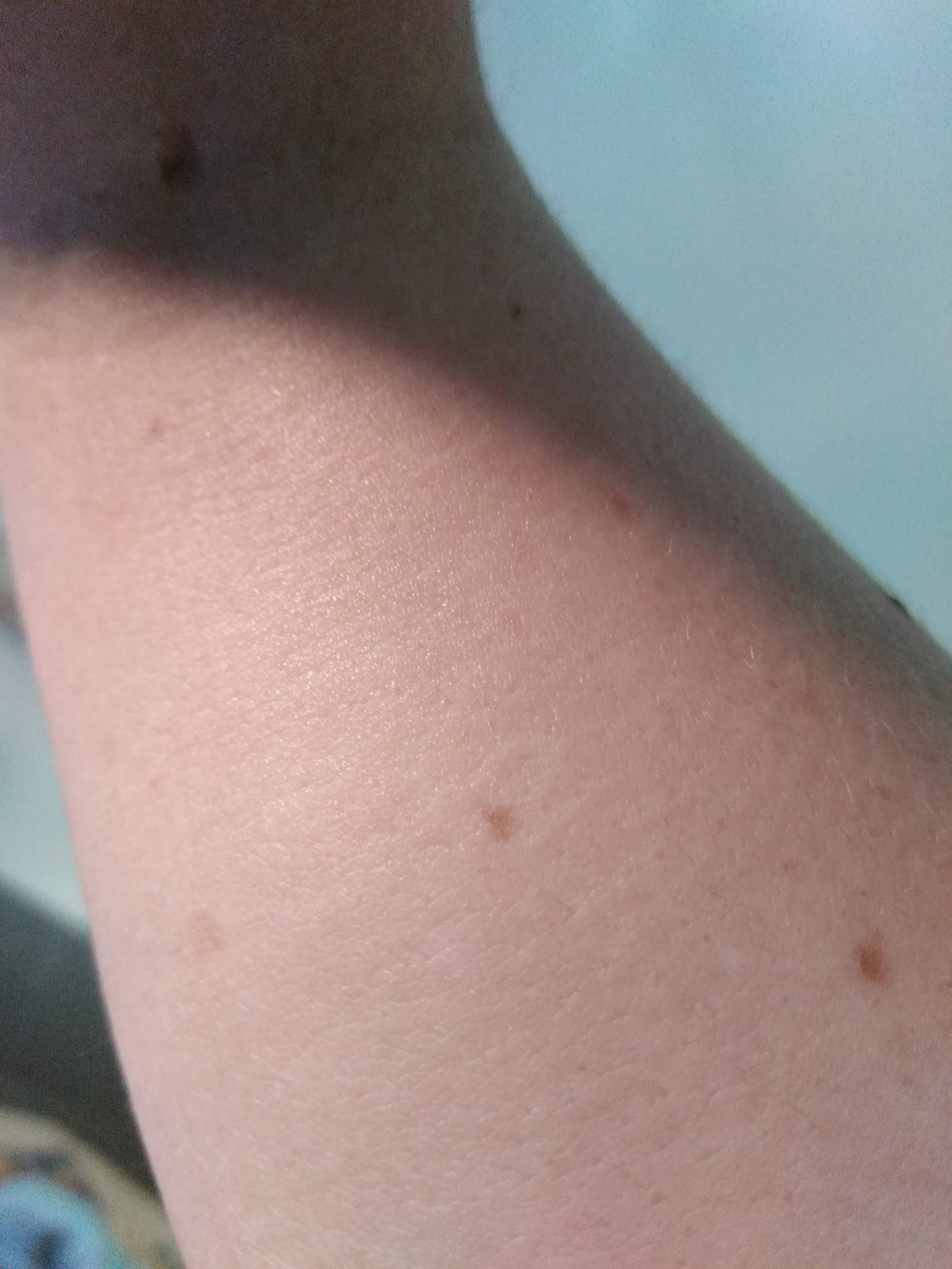 Sind das normale knickfalten oder Risse? (Haut, Hautarzt, Gewebe)